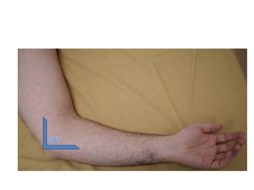 Ulnar Neuropathy at the Elbow (Cubital Tunnel Syndrome) – Neuromuscular ...
