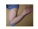 Ulnar Neuropathy at the Elbow (Cubital Tunnel Syndrome) – Neuromuscular ...