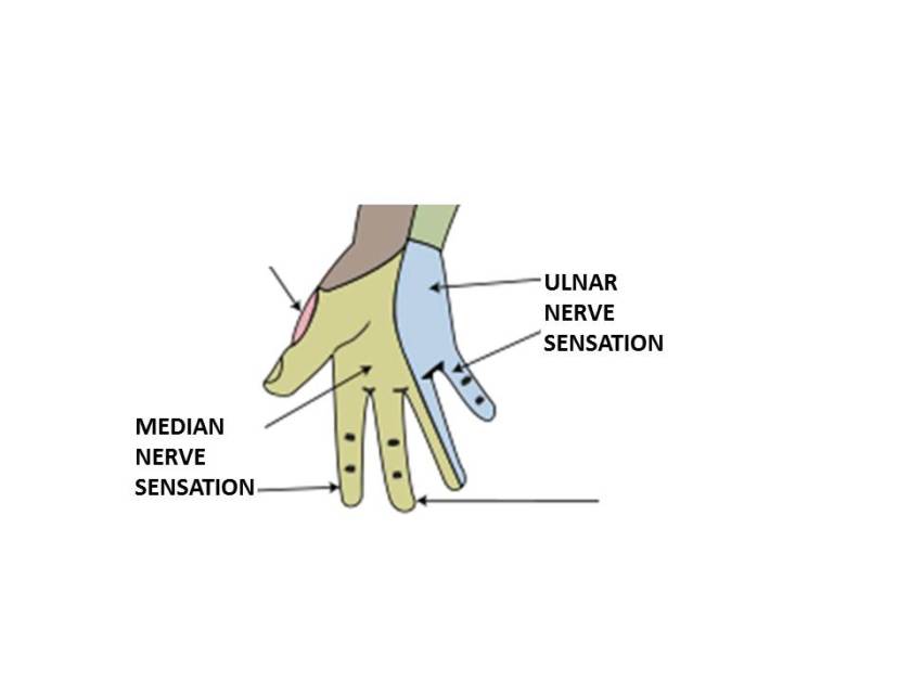Ulnar Neuropathy at the Elbow (Cubital Tunnel Syndrome) – Neuromuscular ...