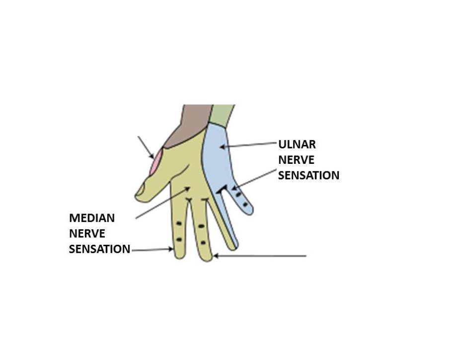 Ulnar Neuropathy at the Elbow (Cubital Tunnel Syndrome) – Neuromuscular ...