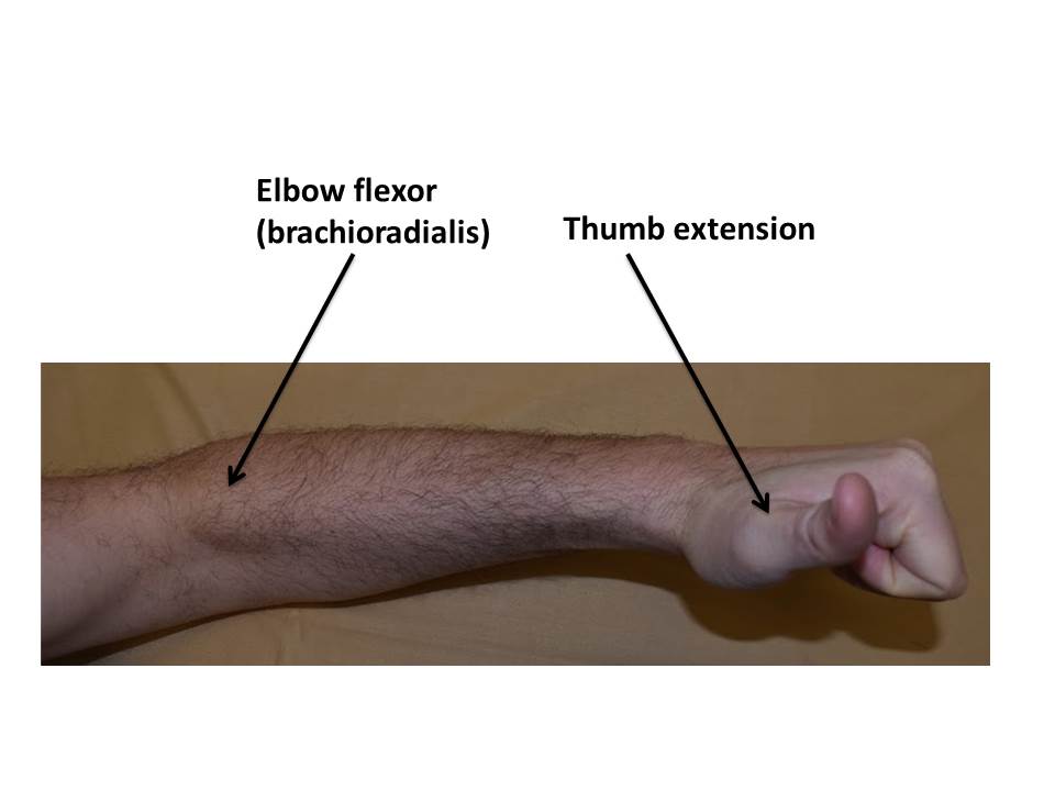 Radial Nerve Palsy (Wrist Drop) – Neuromuscular and Electrodiagnostic ...