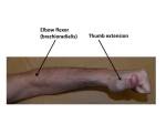 Radial Nerve Palsy (Wrist Drop) – Neuromuscular and Electrodiagnostic ...