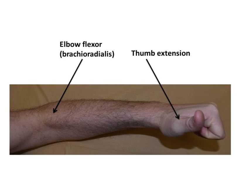 Radial Nerve Palsy (Wrist Drop) – Neuromuscular and Electrodiagnostic ...
