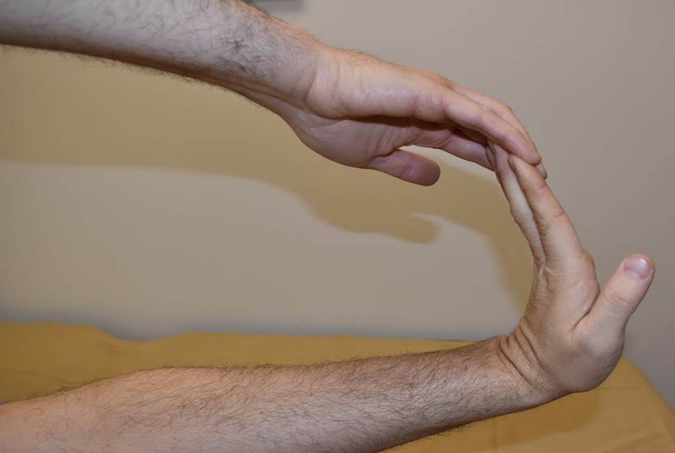 Radial Nerve Palsy (Wrist Drop) – Neuromuscular and Electrodiagnostic ...