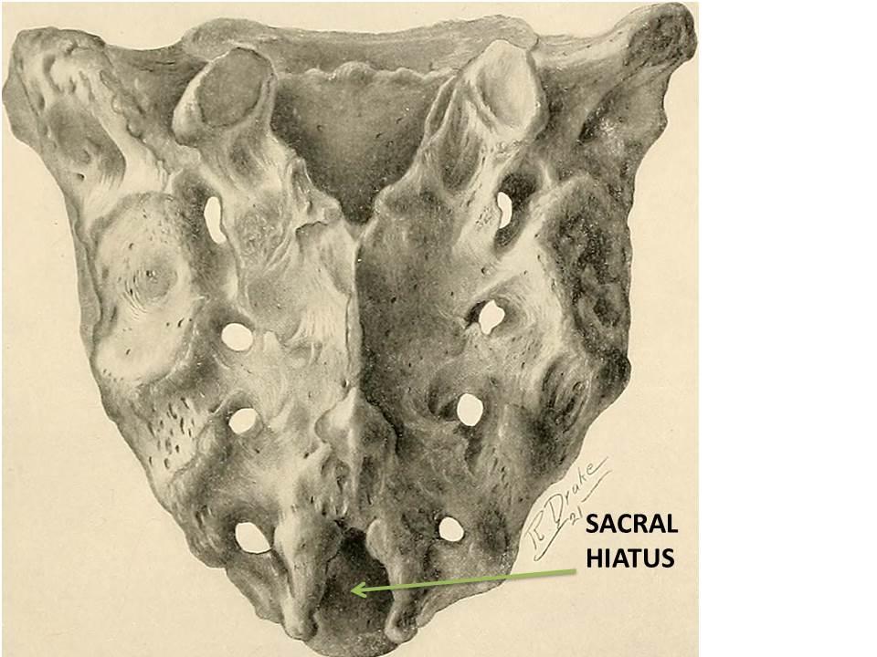 (Caudal) Epidural Steroid Injections – Neuromuscular and ...