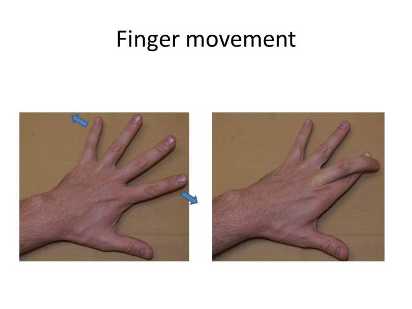Ulnar Neuropathy at the Elbow (Cubital Tunnel Syndrome) – Neuromuscular ...