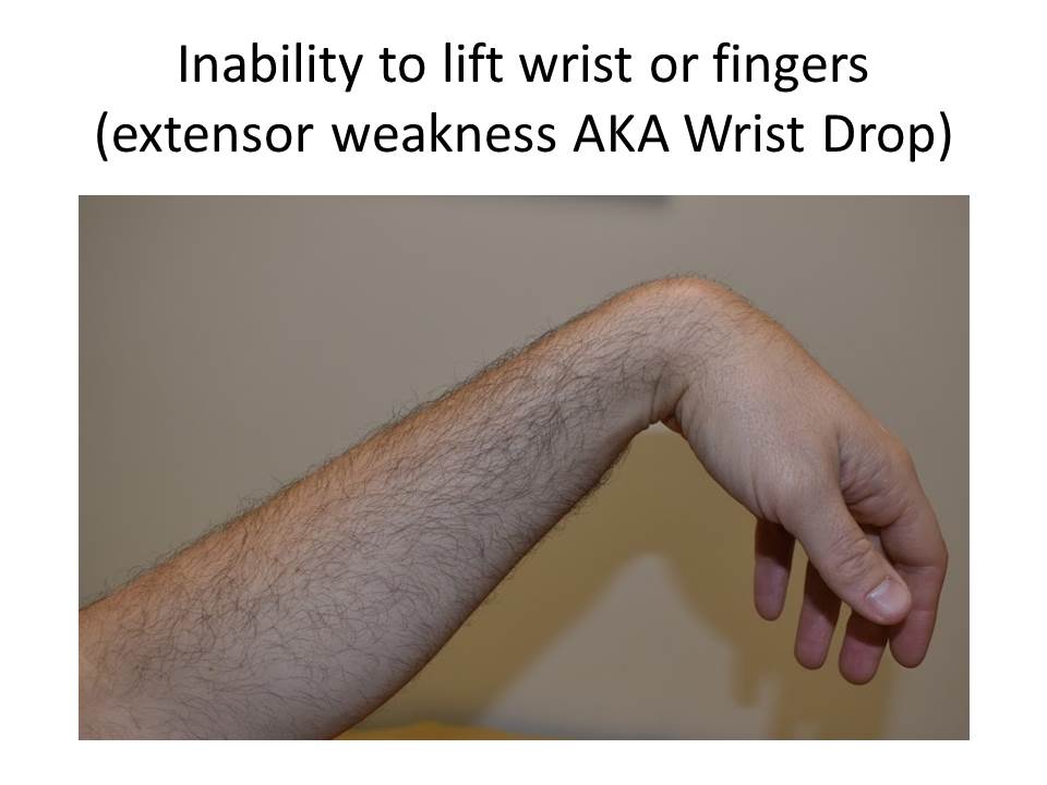 Radial Nerve Palsy (Wrist Drop) – Neuromuscular and Electrodiagnostic ...